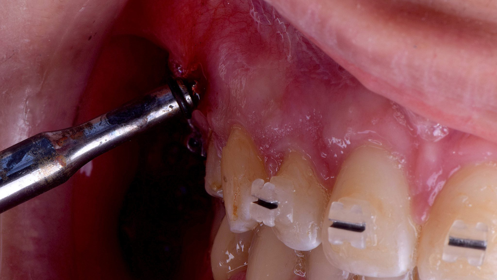 ¿Dónde es mejor colocar los microimplantes?